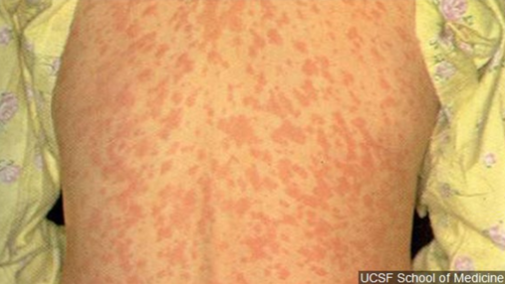 CDC monitoring measles in more than 20 states | WZTV